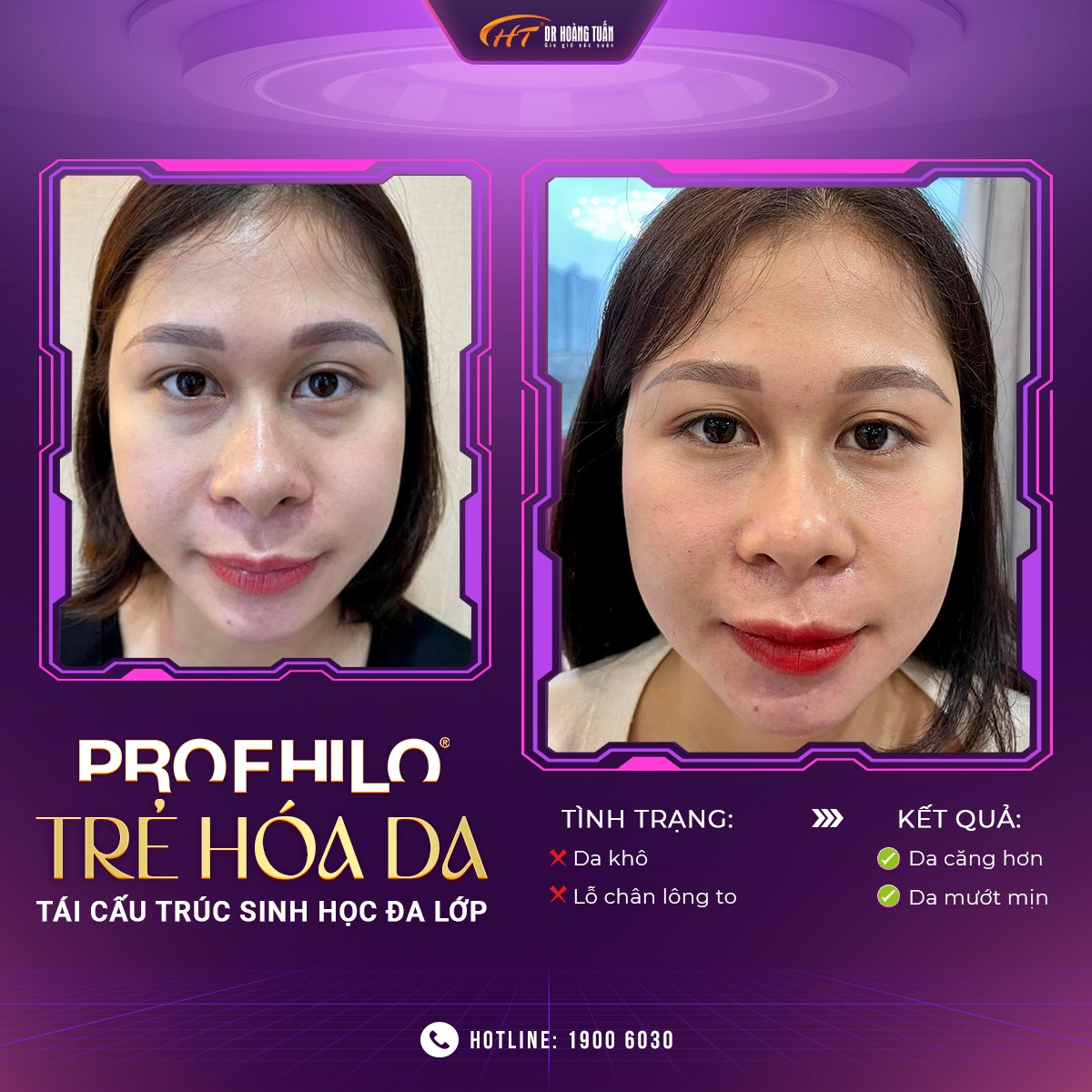 Tiêm 5 điểm Profhilo là gì? Ưu điểm của cách tiêm Profhilo