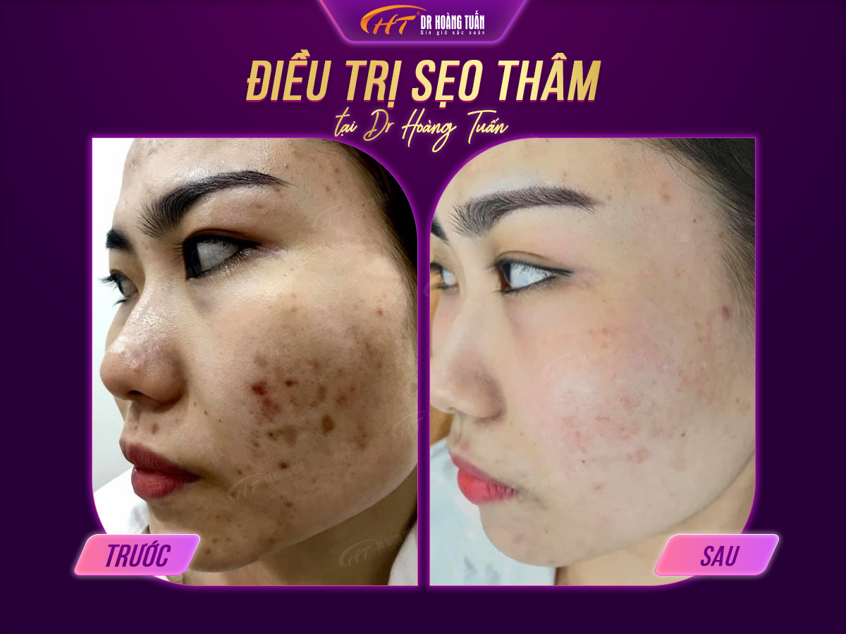 Trị thâm bằng laser và những điều có thể bạn chưa biết