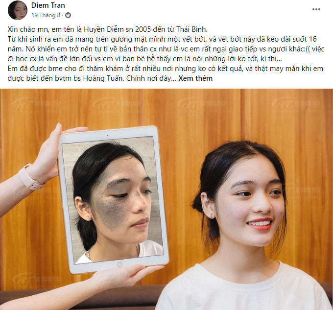 Ra mắt cộng đồng u máu, u mạch máu, bớt đỏ, bớt Ota, chàm bẩm sinh ...