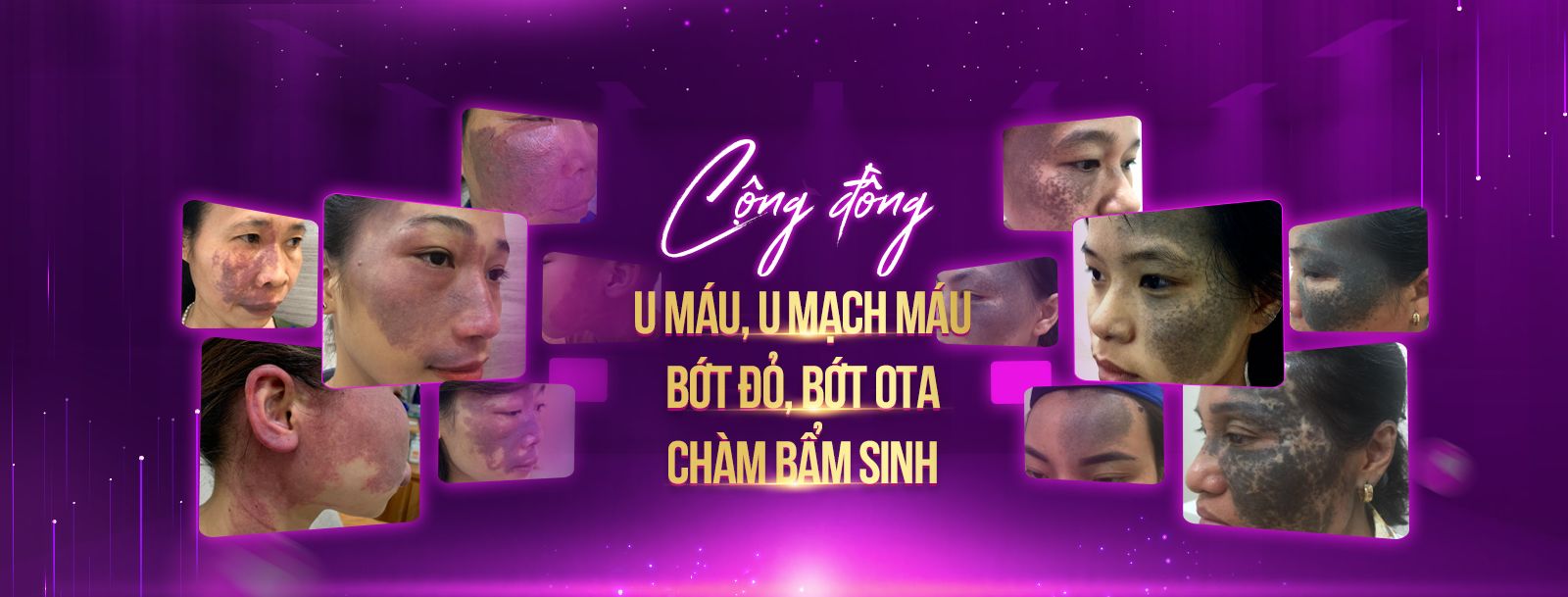 Ra mắt cộng đồng u máu, u mạch máu, bớt đỏ, bớt Ota, chàm bẩm sinh ...