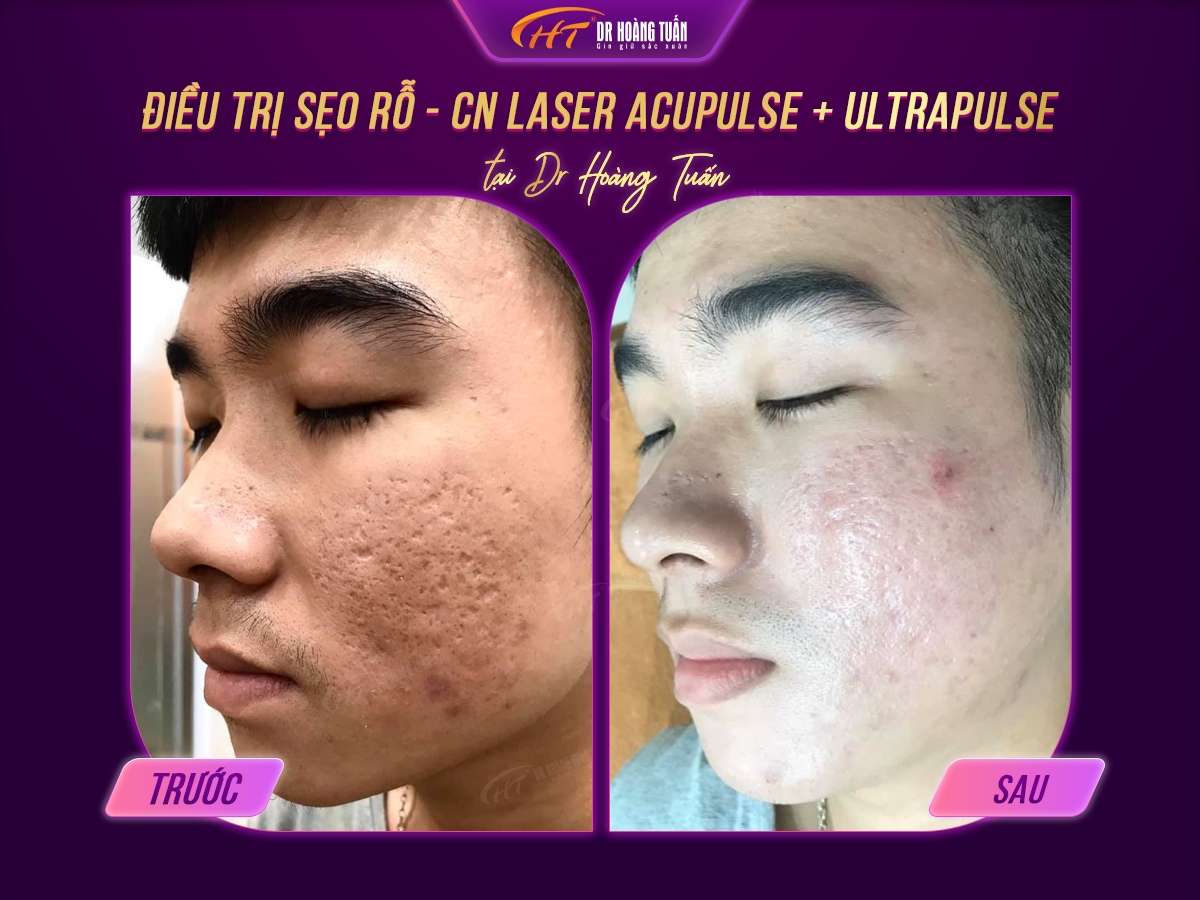 Nguyên nhân và cách điều trị sẹo rỗ sau mụn