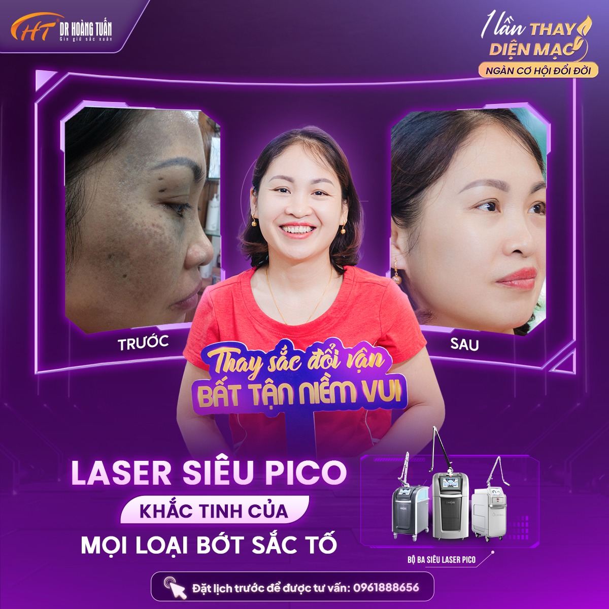 Vết bớt có tẩy được không - Thẩm Mỹ Hoàng Tuấn
